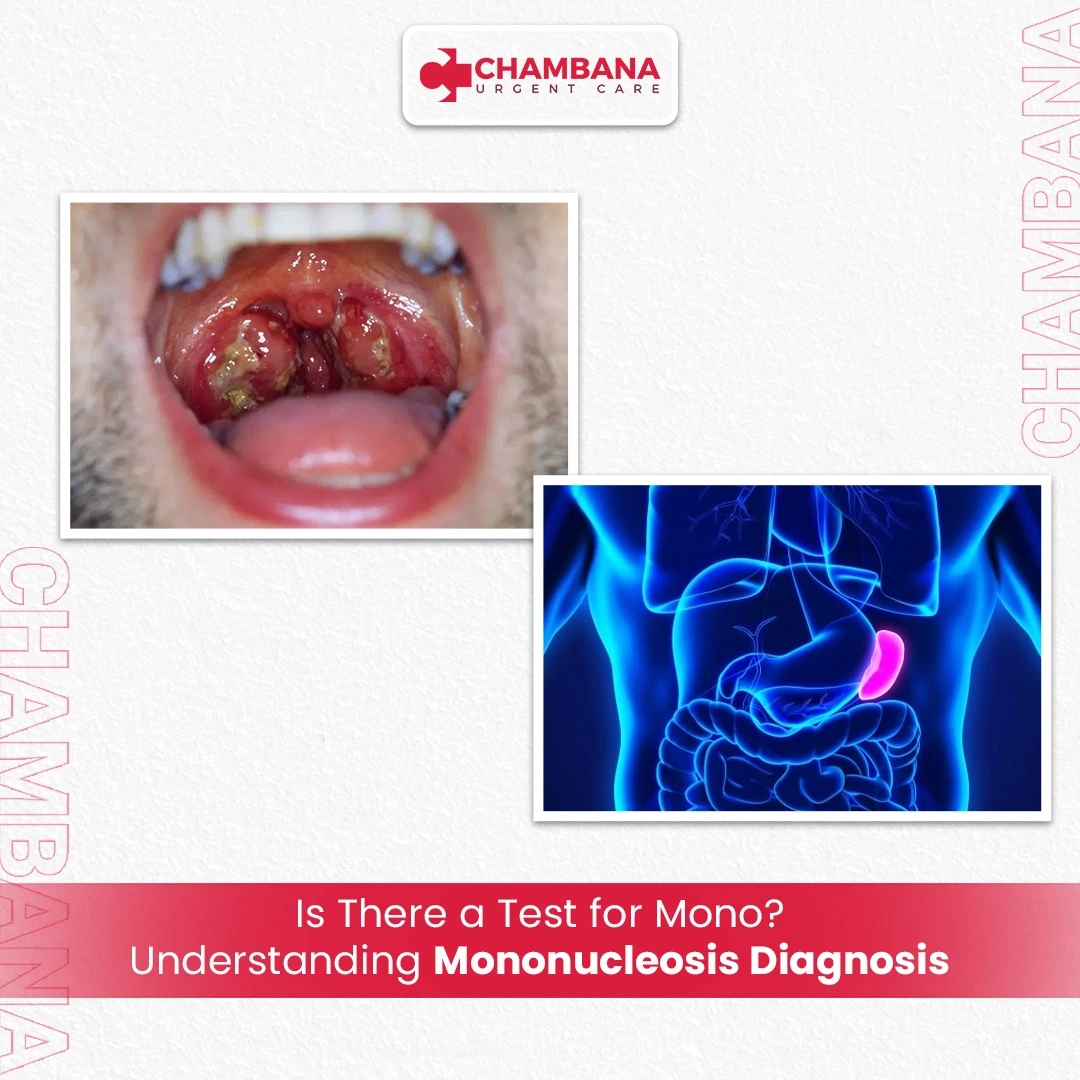Is There a Test for Mono? Understanding Mononucleosis Diagnosis