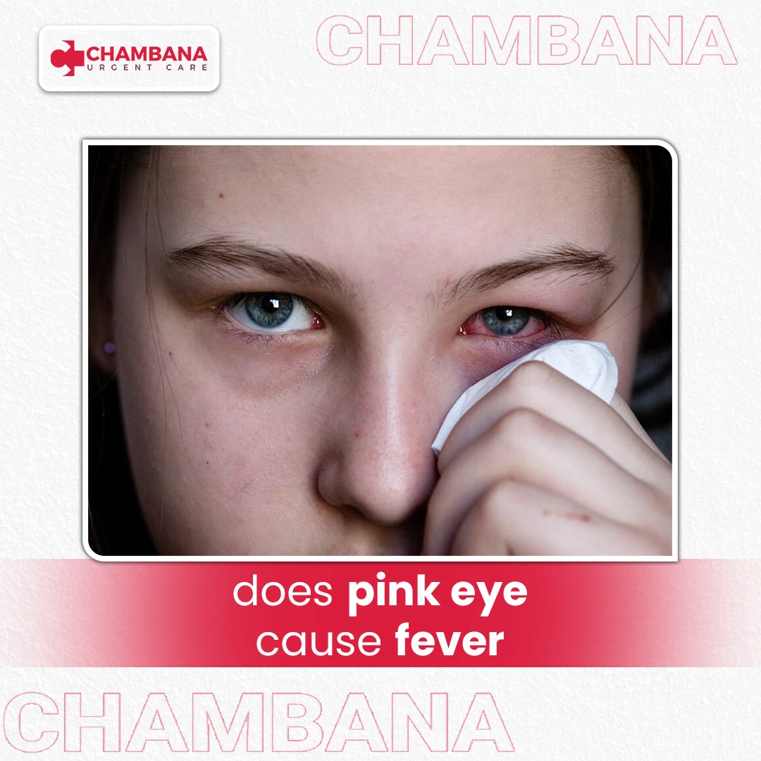 Does Pink Eye Cause Fever? Symptoms and Causes Explained