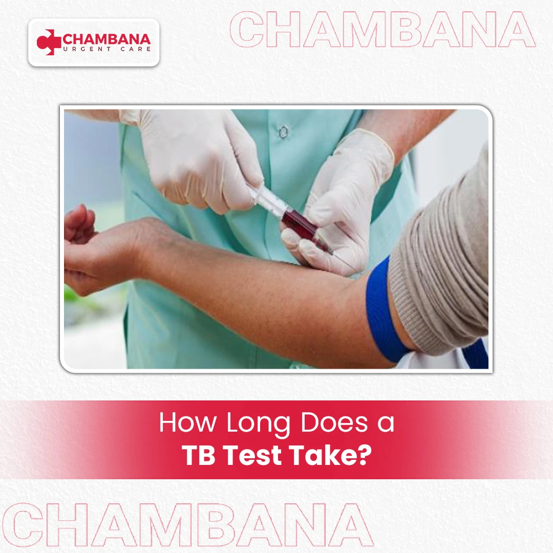 How Long Does a TB Test Take? | Understand the Process